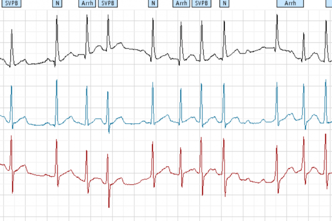 Fibrilatia atriala - Monitorizare holtere EKG